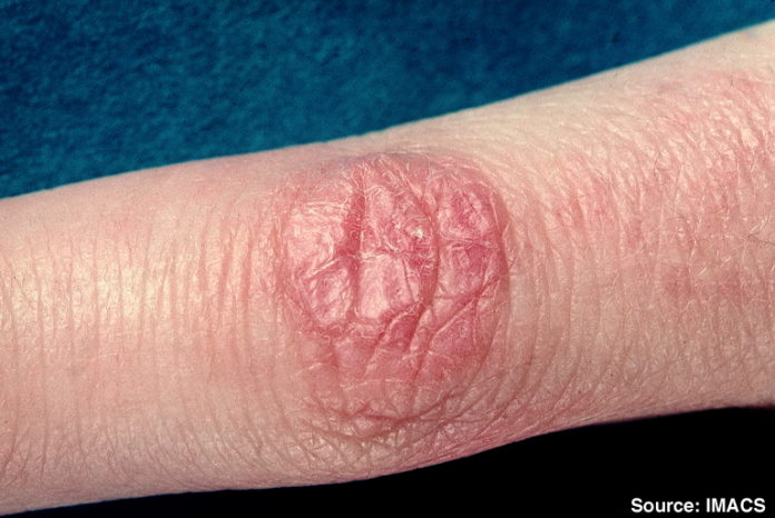 Dermatomyositis - dermRounds Dermatology Network