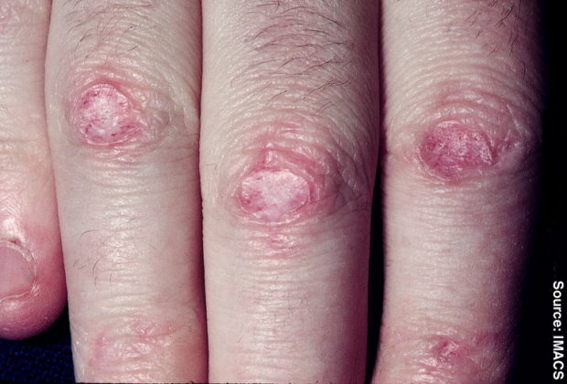 Dermatomyositis - dermRounds Dermatology Network