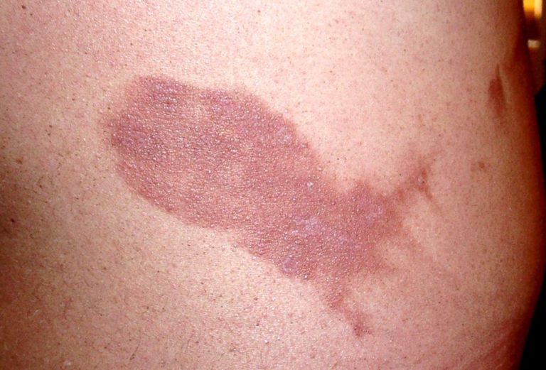 Phytophotodermatitis - dermRounds Dermatology Network